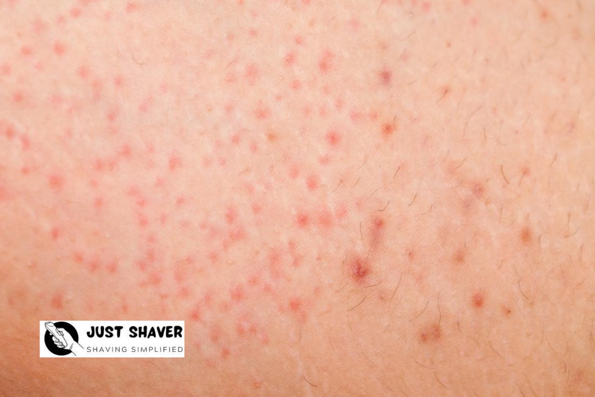 How to Avoid Pimples After Shaving Face With Sensitive Skin - Just Shaver